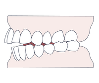 Overjet Explained: Causes, Treatments, & Smile Fixes