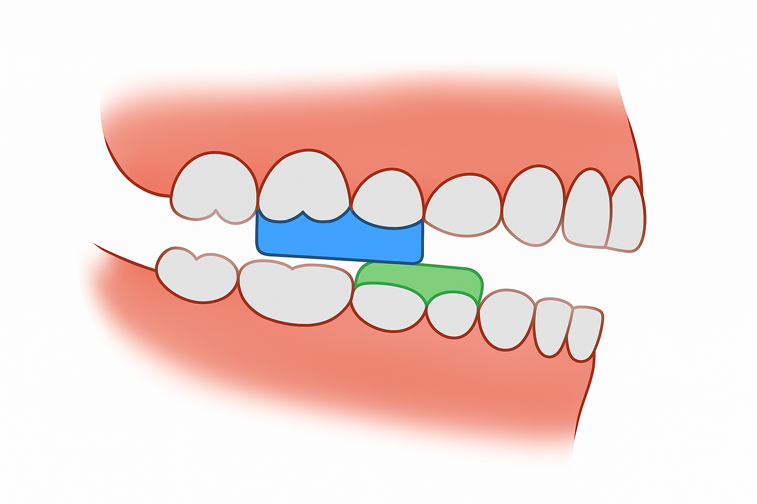 Bite block braces: Purpose, benefits & what to expect – Caspersmile